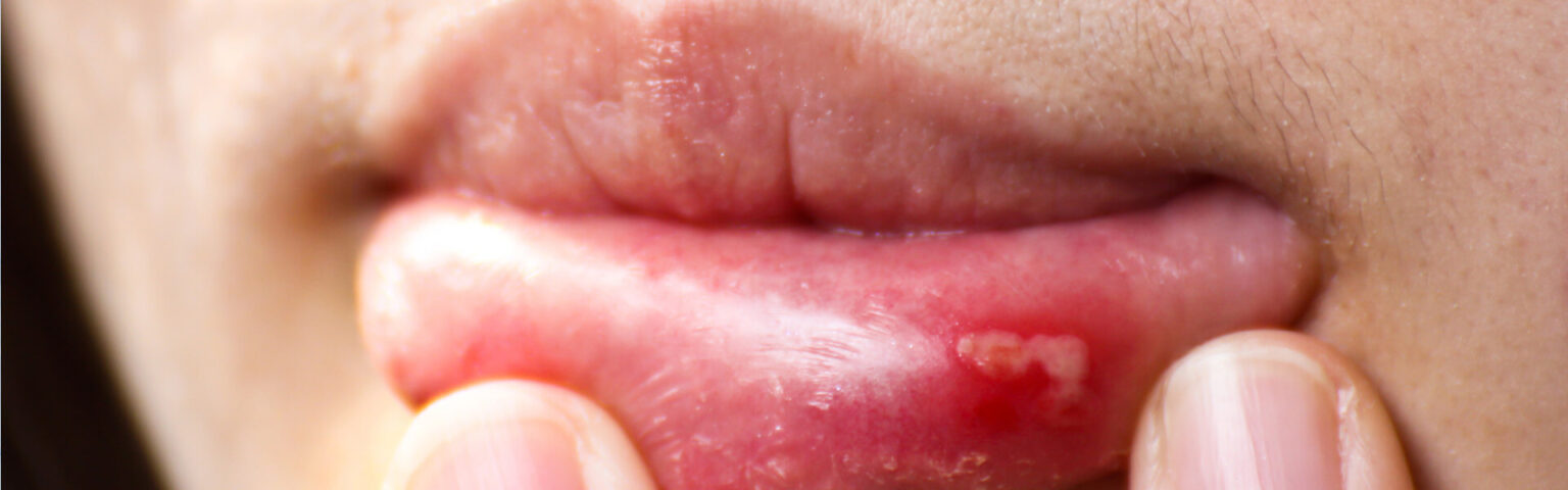 Afta – przyczyny powstawania i sposoby leczenia - Okiem dentystki