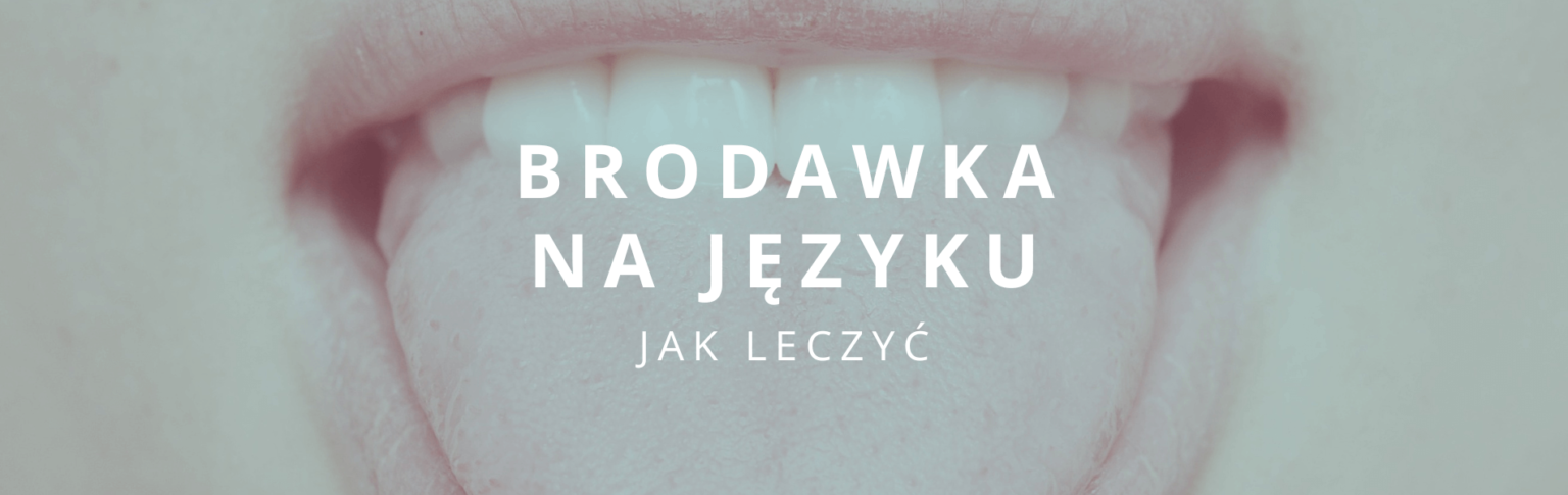 Brodawka na języku: czym jest i jak ją leczyć? - Okiem dentystki