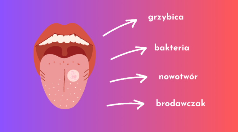 Brodawka na języku: czym jest i jak ją leczyć? - Okiem dentystki